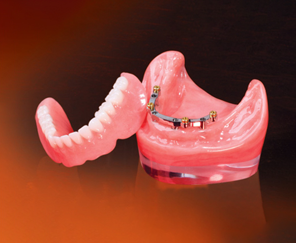 Implant Overdentures | Preferred Dental Laboratory
