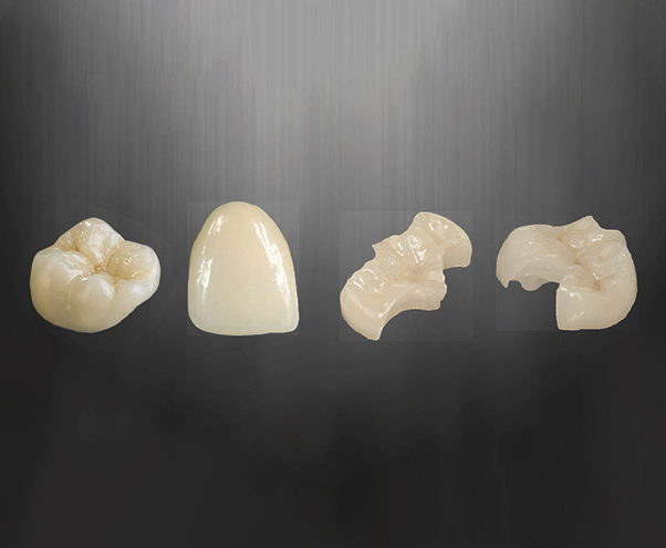 Emax Dental Crowns & Restorations | Aesthetic Solutions