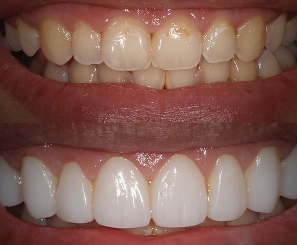 Layered Zirconia for Dental Restorations | Preferred Dental Laboratory
