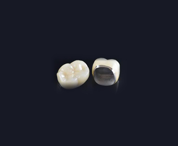 PFM Crowns for Dental Restorations | Preferred Dental Laboratory