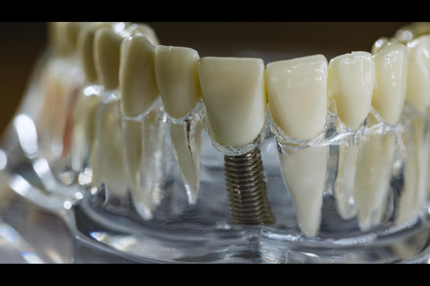 Crown and Bridge Implants: The Ultimate Solution for Missing Teeth
